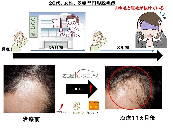 円形脱毛症、皮膚科治療が無効で放置も、眉毛と睫毛が抜け始めて来院。 患者様からの声・メディア掲載・クリニックからのお知らせ 名古屋kクリニック